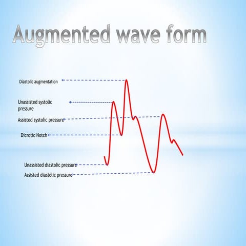 Iabp wave forms | PPTX