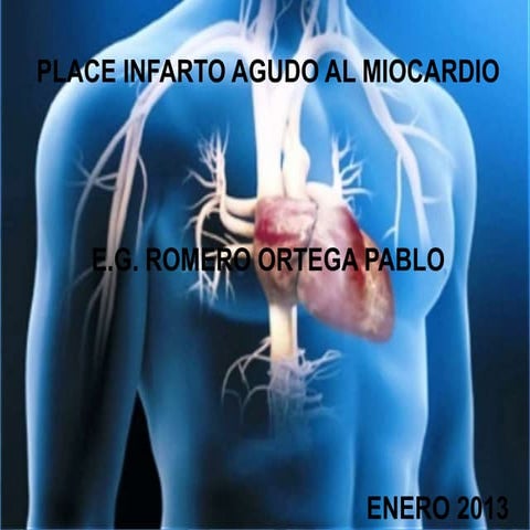 Infarto Agudo al Miocardio | PPTX