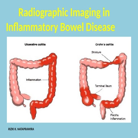 Inflammatory Bowel Disease (IBD) Explanation | PPTX