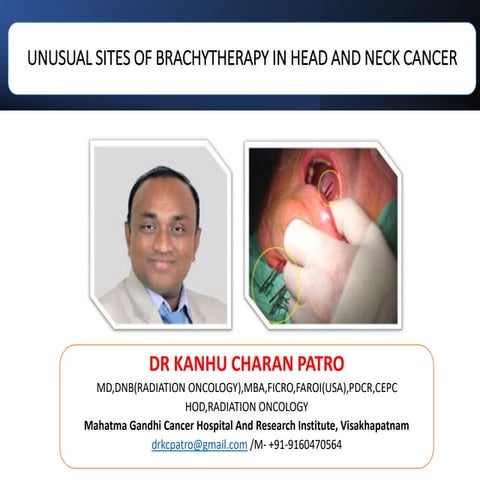 UNUSUAL SITES OF BRACHYTHERAPY IN HEAD AND NECK CANCER | PPTX