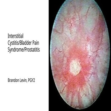 interstitial cystitis treatments and management | PPTX