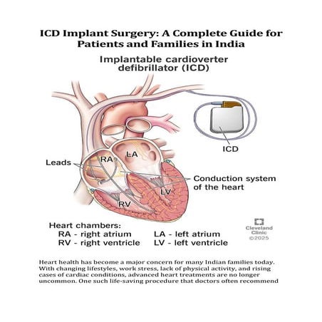 ICD Implant Surgery: A Complete Guide for Patients and Families in ...