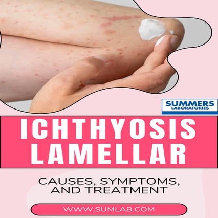 What is the best treatment for lamellar ichthyosis? | PDF