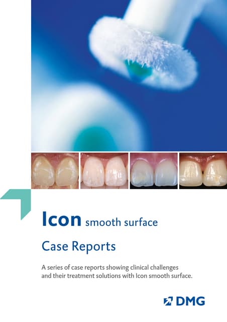 Gingival prosthesis: an efficient solution to severe gingival recessions in aggresssive ...