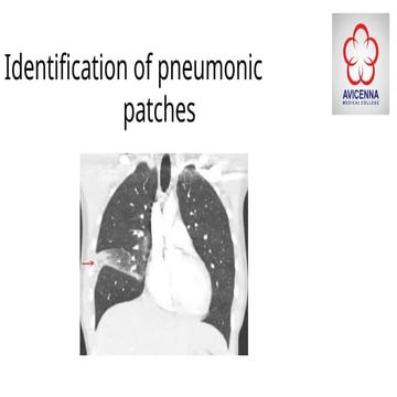 Identification of pneumonic patches.pptx
