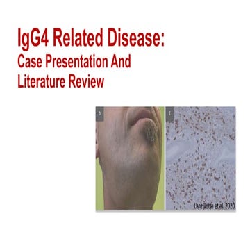 IgG4 Related Disease: Case Presentation And Literature Review | PPTX