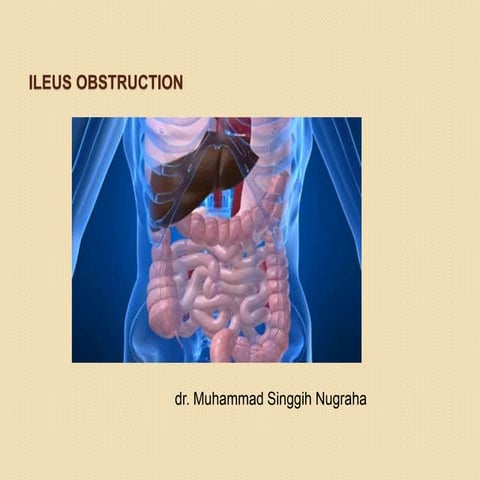 Ileus obstruktif | PPTX