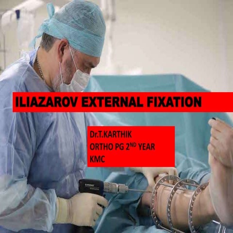 Ilizarov | PPTX