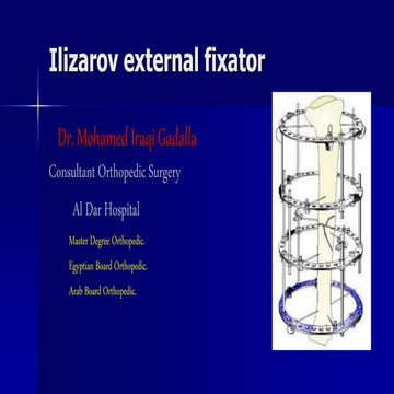 Ilizarov external fixator | PPTX