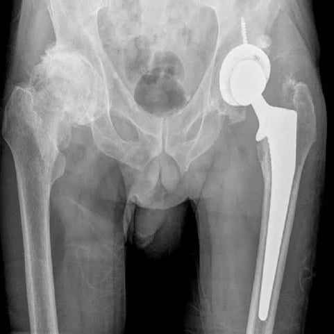 X-ray for total hip replacement | PDF