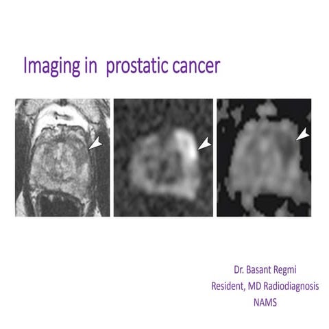 Imaging in prostatic patholgy | PPTX