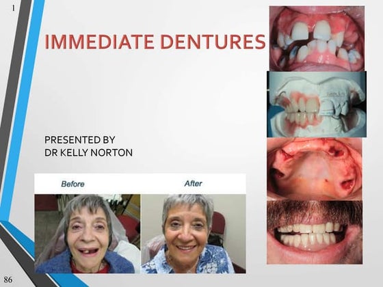 Complete overdenture(3) | PPT