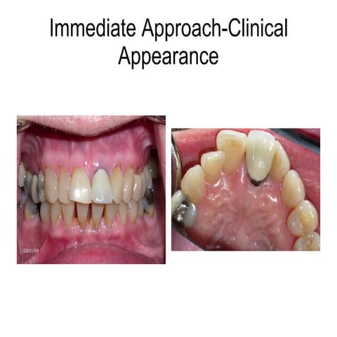 Immediate extraction ridge graft and implant placement | PPT