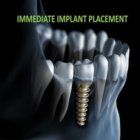 immediate dental implants placement.pptx