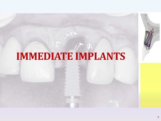 Implant | PPT