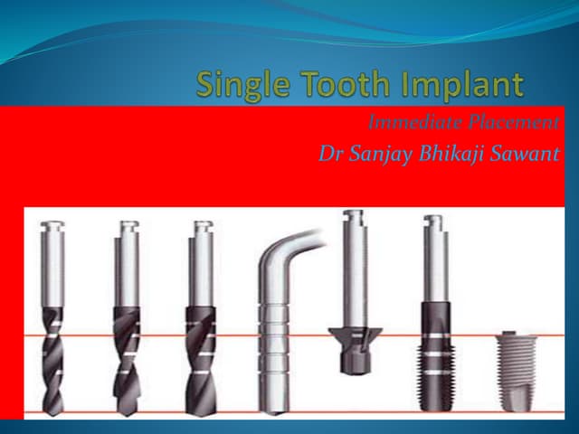 PATIENT SPECIFIC IMPLANTS.pptx