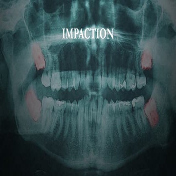 Impaction- definition, theories, indications, surgical techniques | PPT