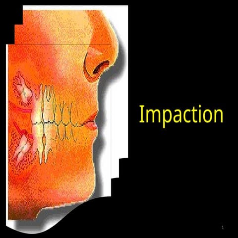 Mandibular 3rd molar impactions | PPTX