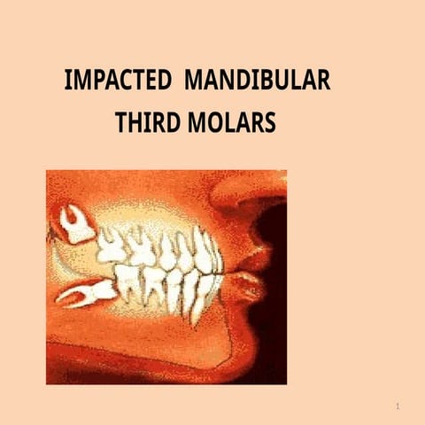 THIRD MOLAR IMPACTION (BASIC) | PPTX