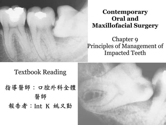 31.embedded and impacted teeth | PPTX | Dental Health | Diseases and ...