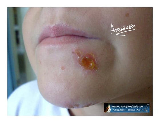 Impetigo | PPTX | Infectious Diseases | Diseases and Conditions