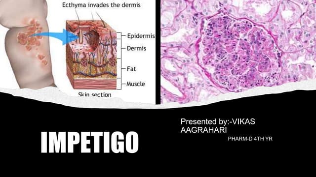 Impetigo | PPTX | Infectious Diseases | Diseases and Conditions