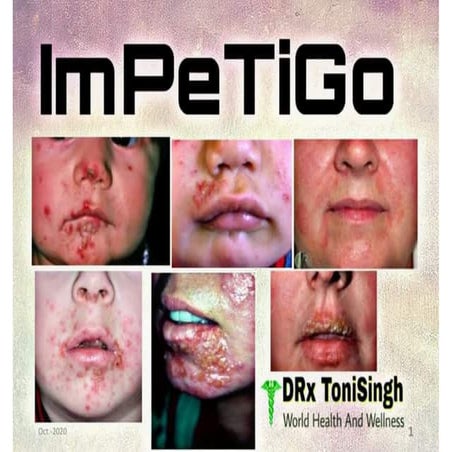 Impetigo | PDF | Infectious Diseases | Diseases and Conditions