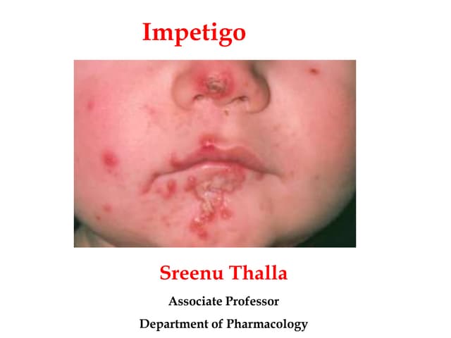 Impetigo | PPTX | Infectious Diseases | Diseases and Conditions