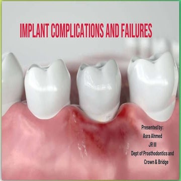 implants complications and failures.pptx