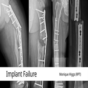 IMPLANT FAILURE in Orthopedic cases (1).pptx
