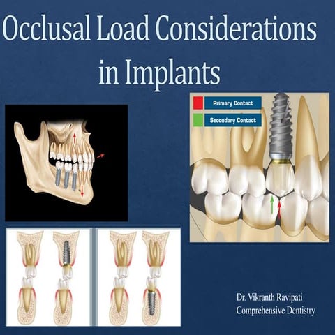 Implant Occlusion.pptx