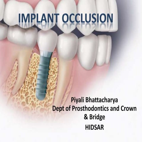 Implant prosthesis occlusion | PPTX