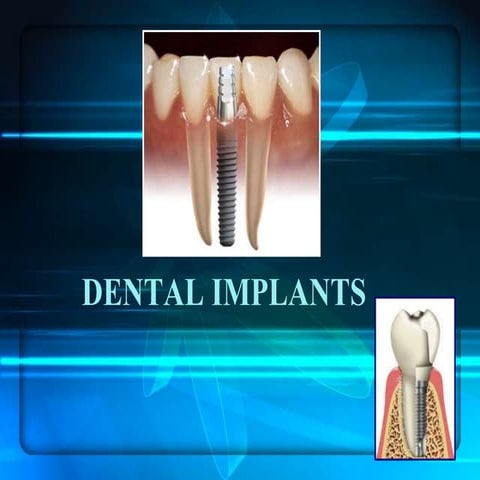 Dental Implants Introduction | PPT