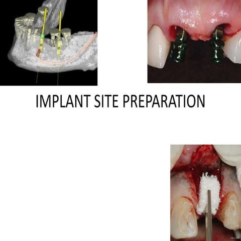 IMPLANT SITE PREPARATION.pptx