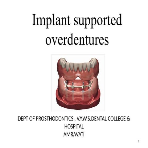 implant supported overdentures -general considerations.pptx