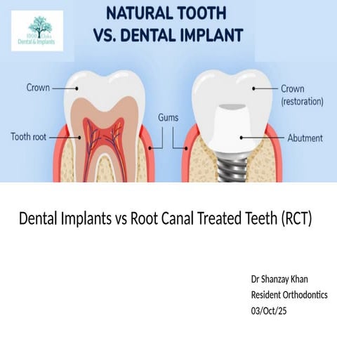 Implant_vs_RCT_Presentation ………………:.:.:: | PPTX