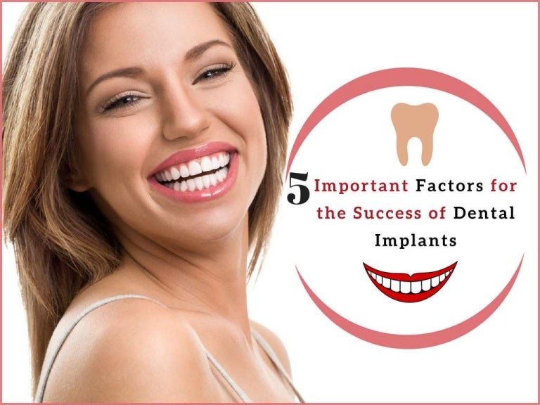 5 Important Factors For Success Of Dental Implants Treatment 5-important-factors-for-success-of-dental-implants-treatment