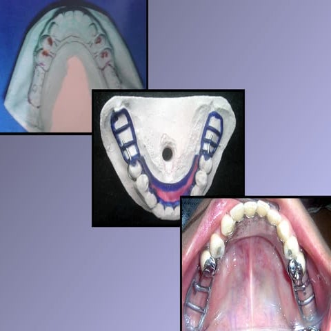 Impression techniques in removable partial dentures | PPT