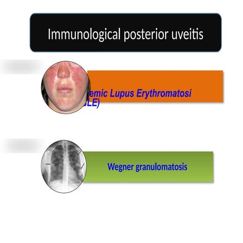auto immune diseases associated uveitis.pptx