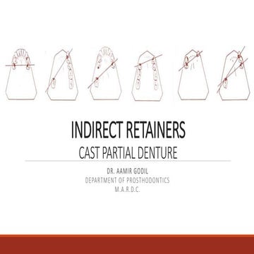 Indirect retainers | PPTX