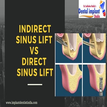 Indirect sinus lift vs Direct sinus lift | PDF