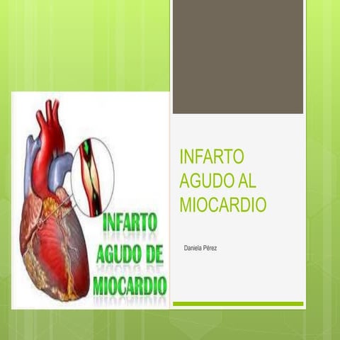 Infarto agudo-al-miocardio | PPTX