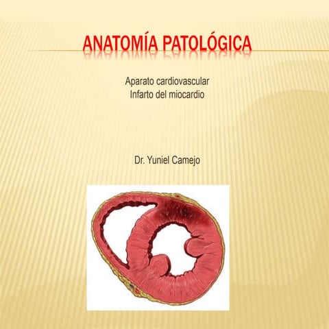 Infarto del miocardio | PPTX
