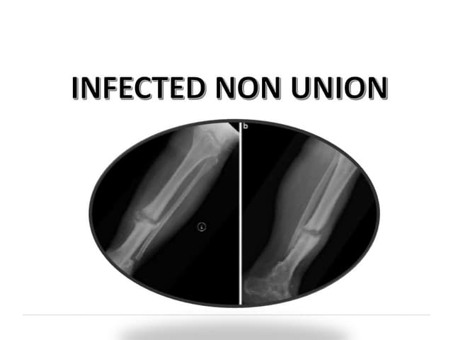 Nonunion definition, causes, classification and management | PPTX