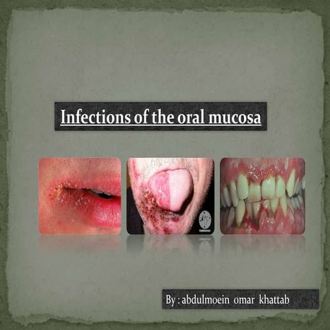 Infection of oral mucosa | PPTX