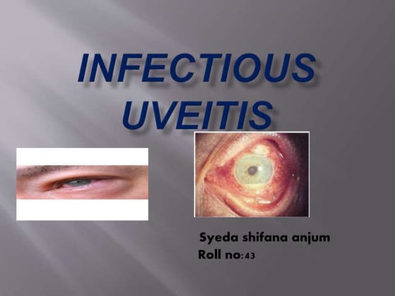 Ocular Histoplasmosis: About A Case | Crimson Publishers | PDF