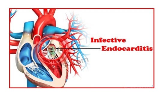 Cardiovascular system Endocarditis-11 (Muhadharaty).ppt