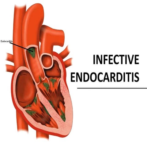 Infective Endocarditis Paediatrics | PPTX