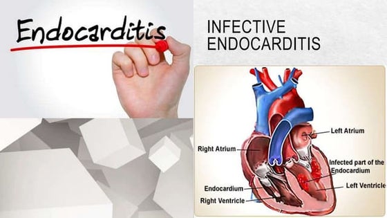 Infective Endocarditis Paediatrics | PPTX