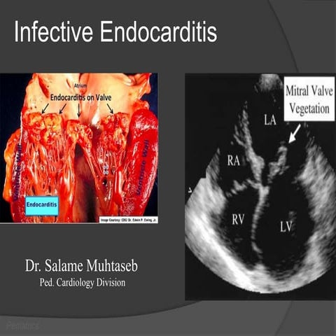 Infective Endocarditis.ppt